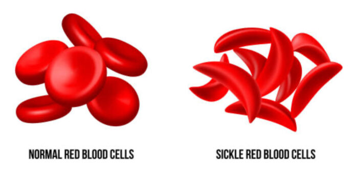 Facts about Sickle Cell Disease – Sickle Gene International Foundation